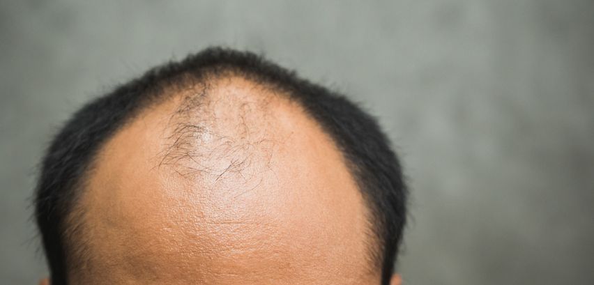 Erblich bedingter Haarausfall: Androgenetische Alopezie (AGA)